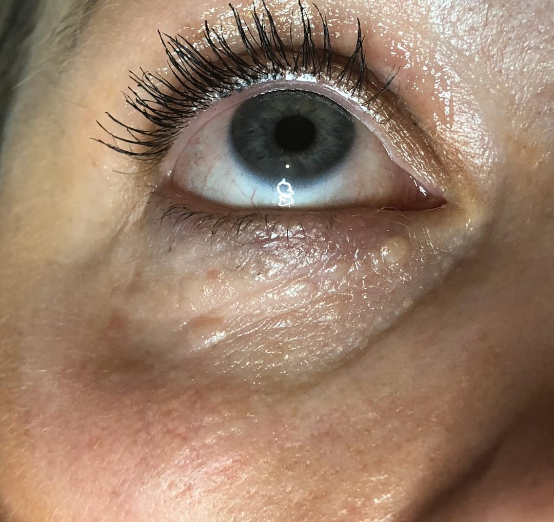 Sebaceous Hyperplasia